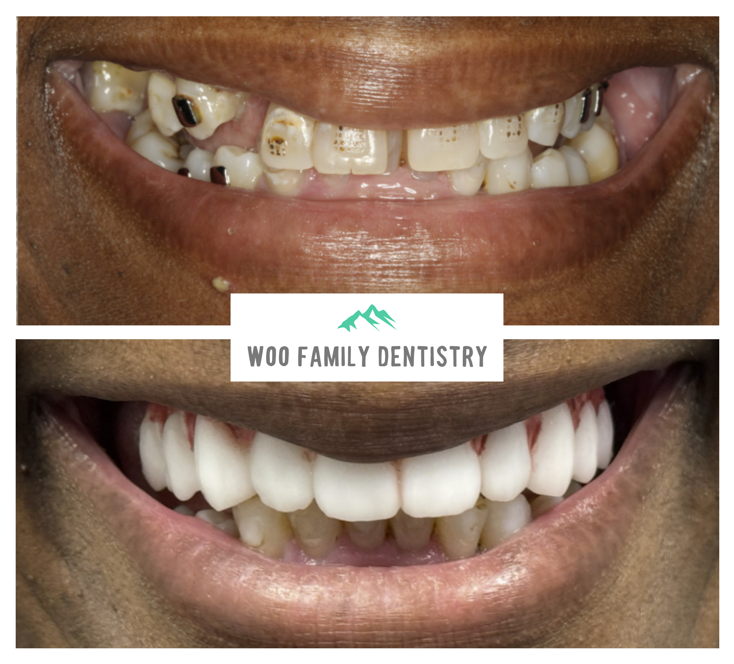 Tooth Replacement | Woo Family Dentistry